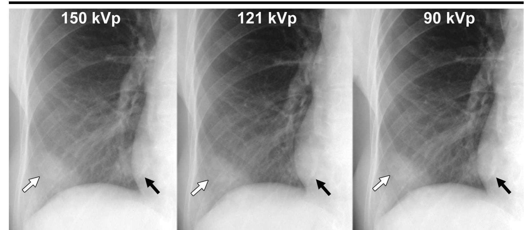 Posteroanterior chest radiographs in 46-year-old female