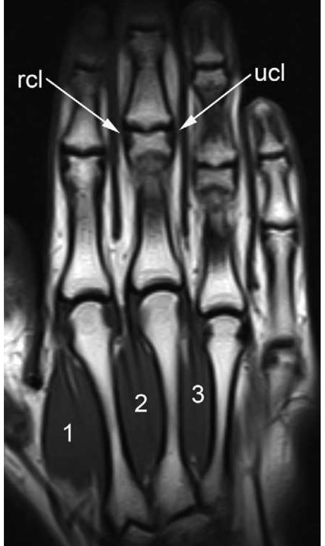 Normal hand. coronal t1-weighted mr image of the hand