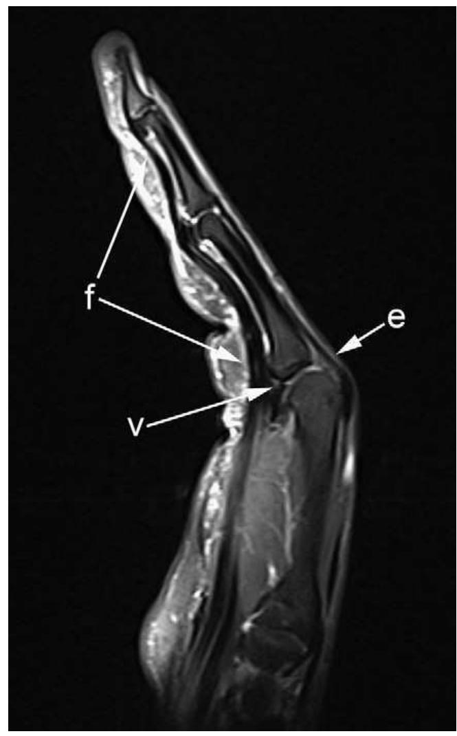 Normal hand. sagittal t2-weighted mr image of the hand with