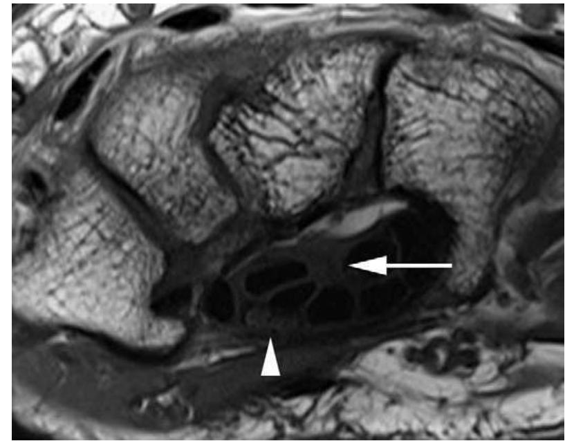 Anomalous proximal origin of the lumbrical muscle (arrow)