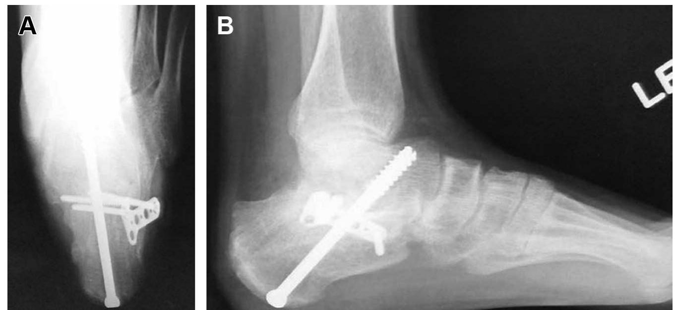 Figure 26 - The Spectrum of Indications for Subtalar Joint