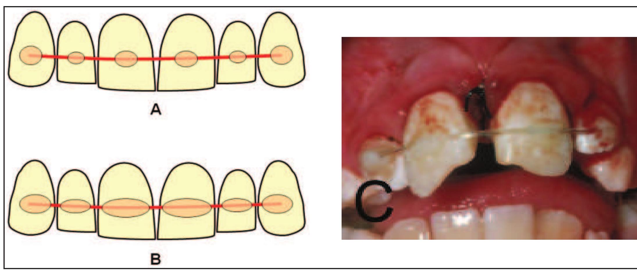 A) schematic diagram of a simple splint. the splinting