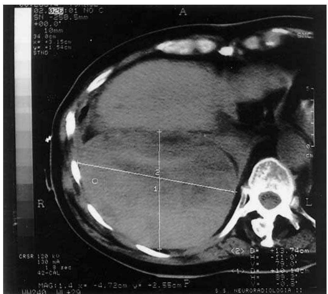 Thoracic ct scan shows the largest size of retropleural