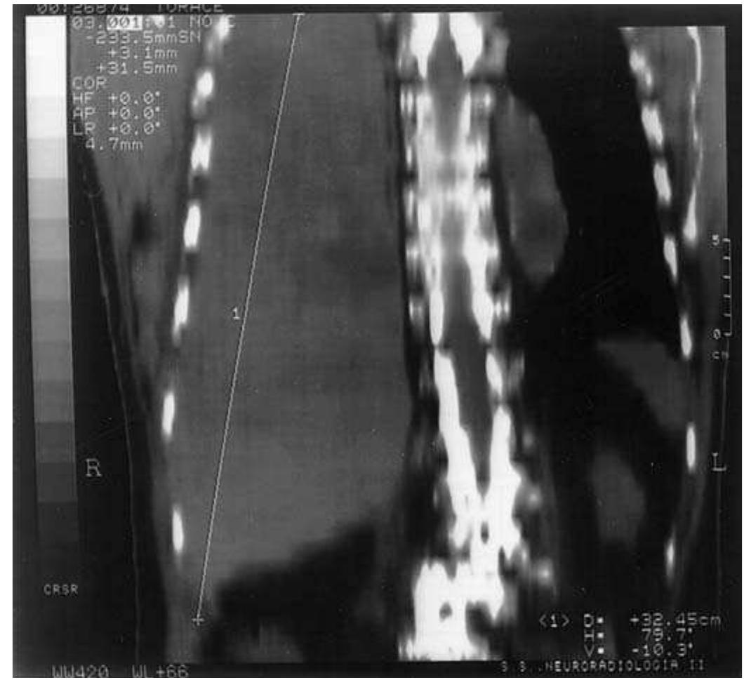 Thoracic ct scan shows the retropleural hematoma filling the