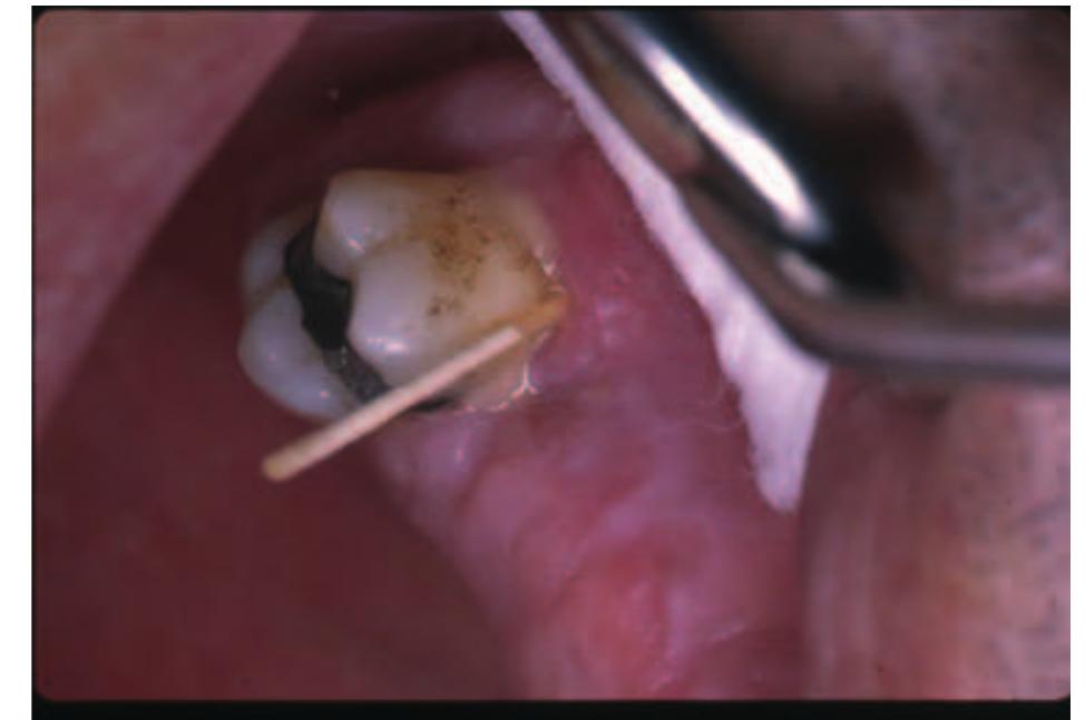Microbiological sampling in a periodontal abscess.