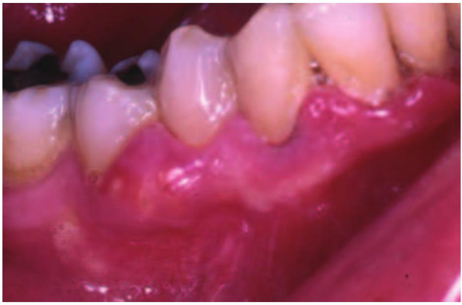 Periodontal abscess in untreated periodontitis.