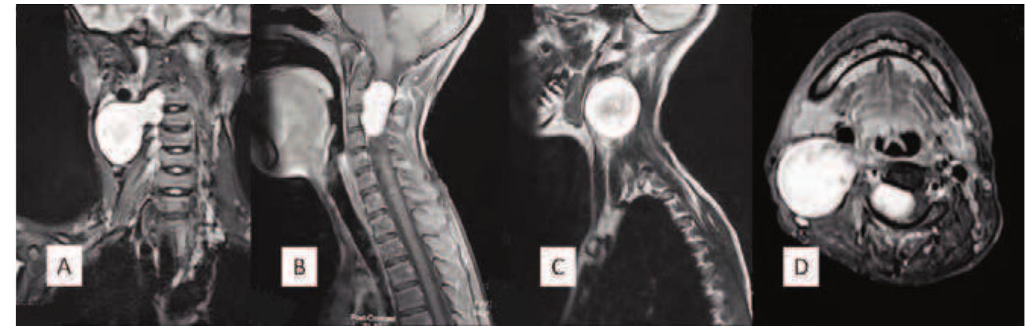 . 1: mri of the cervical spine (a) coronal t1-weighted image