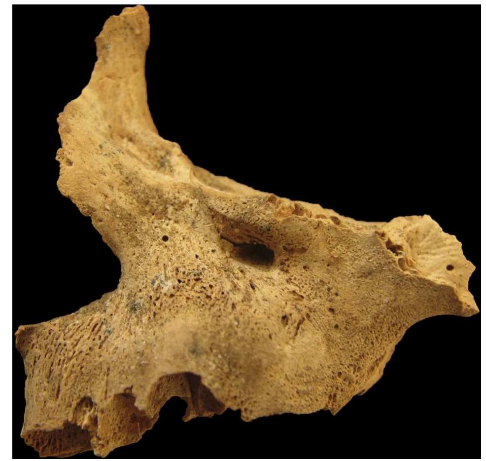 2 left maxilla showing abnormal porosity and new bone