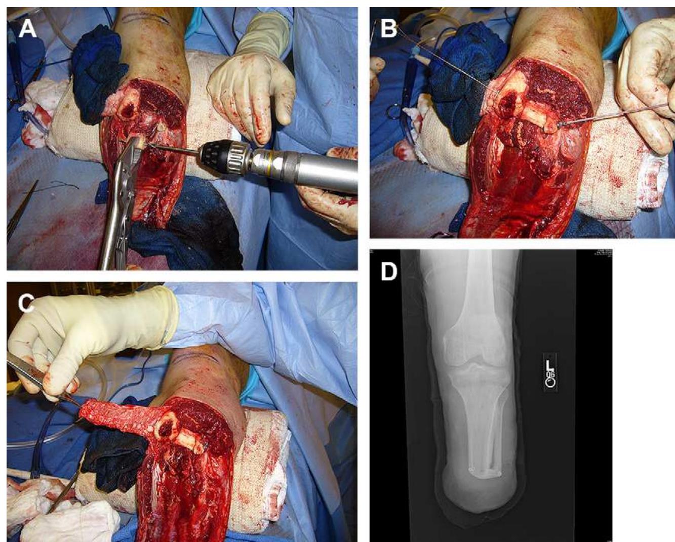 Distal tibiofibular bone bridge synostosis with