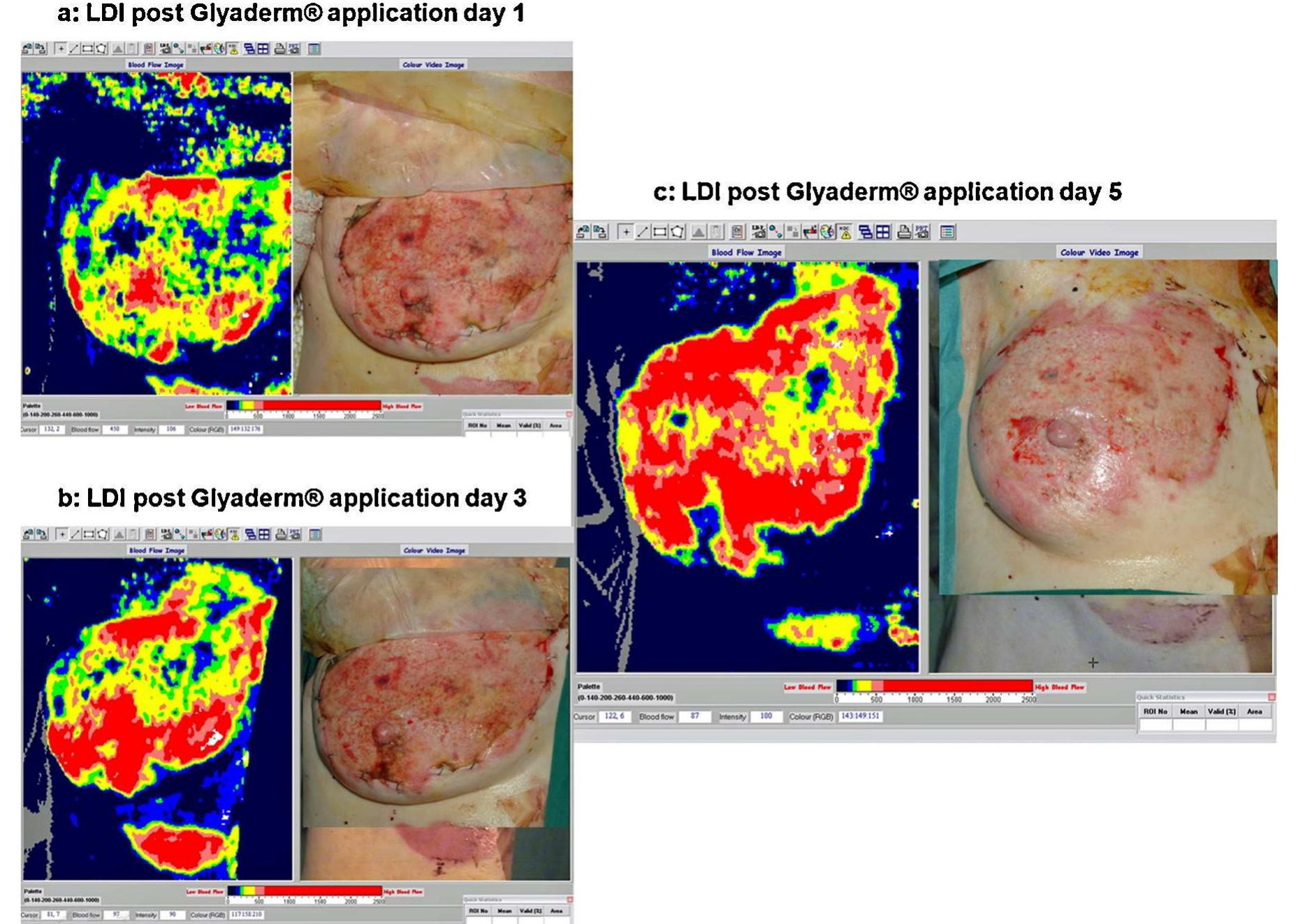 - laser doppler imaging of glyaderm® vascularization.