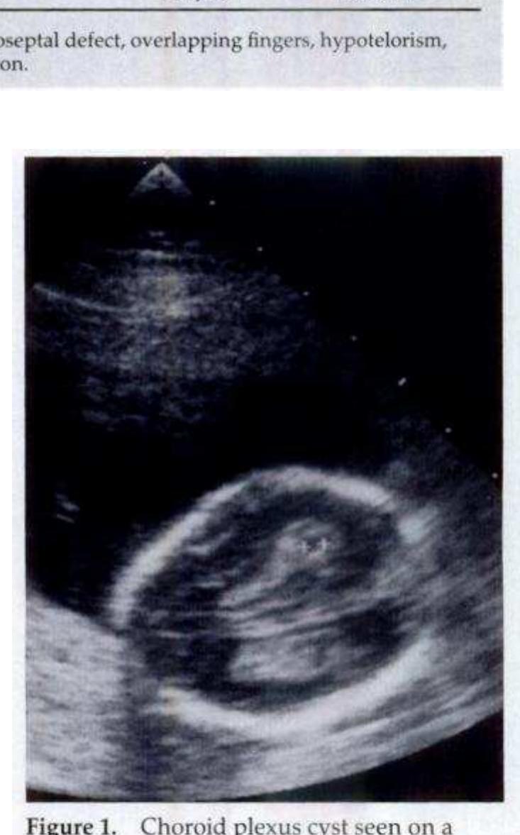 Choroid Plexus Cyst Ultrasound