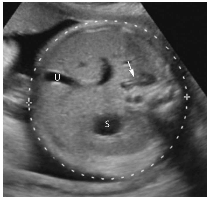 Normal fetal adrenal. transverse plane. this image of the