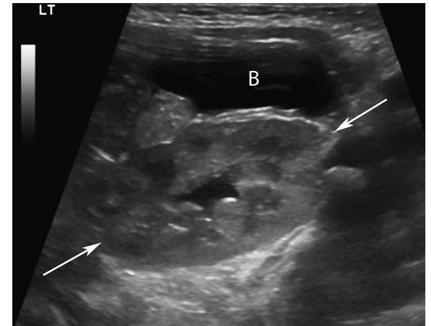 Pelvic kidney. ultrasound. pelvis, left parasagitta plane. a