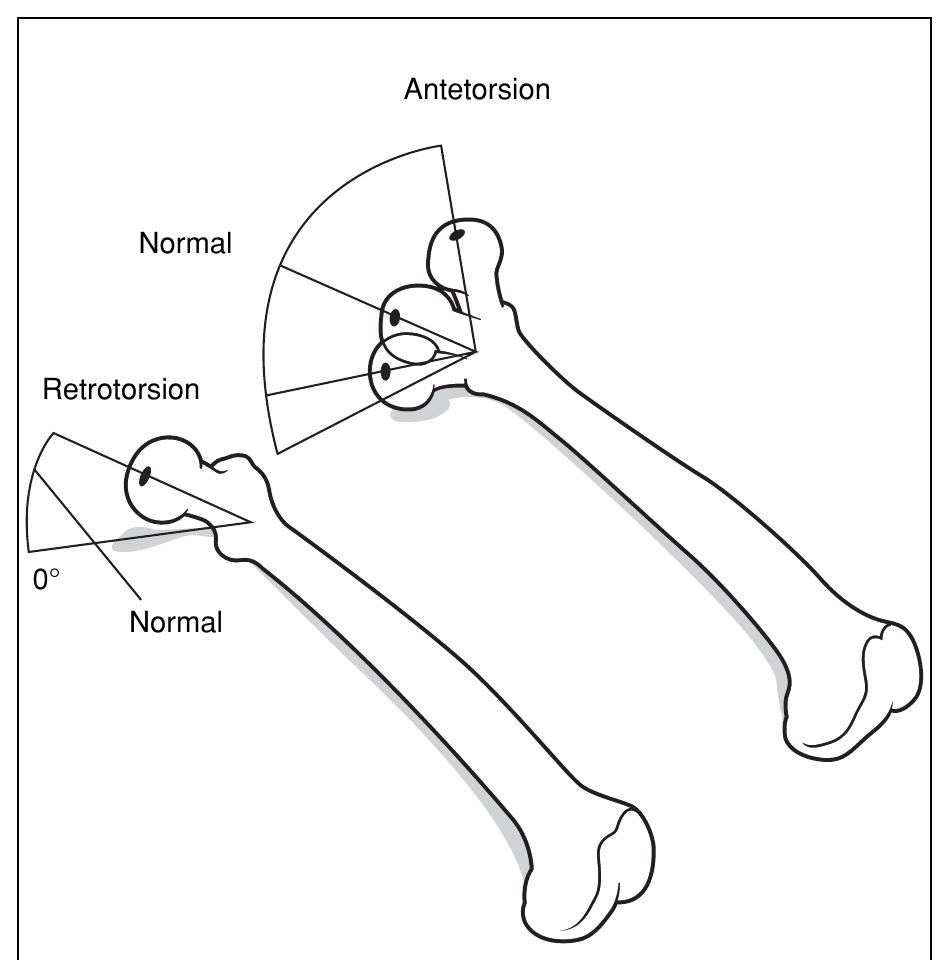 2. angle of declination of the femoral neck normal alignment