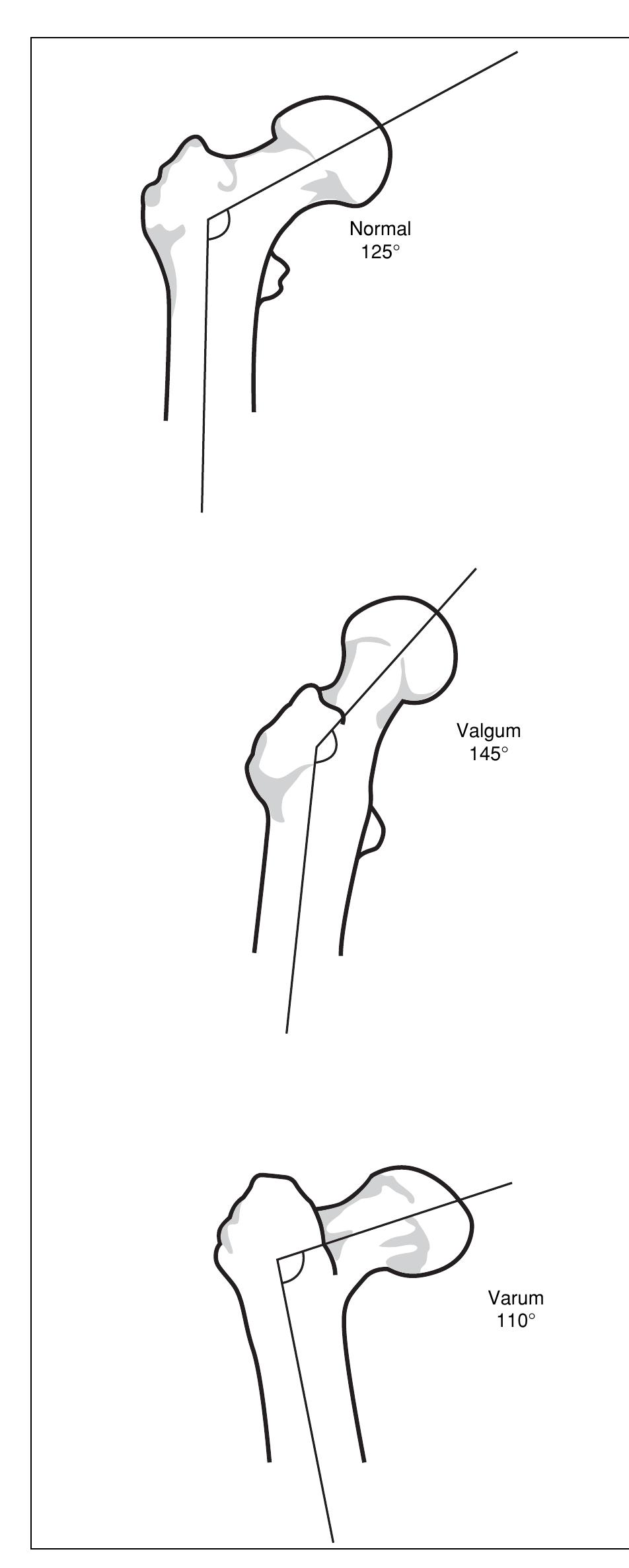 3. angle of inclination of the femoral neck
