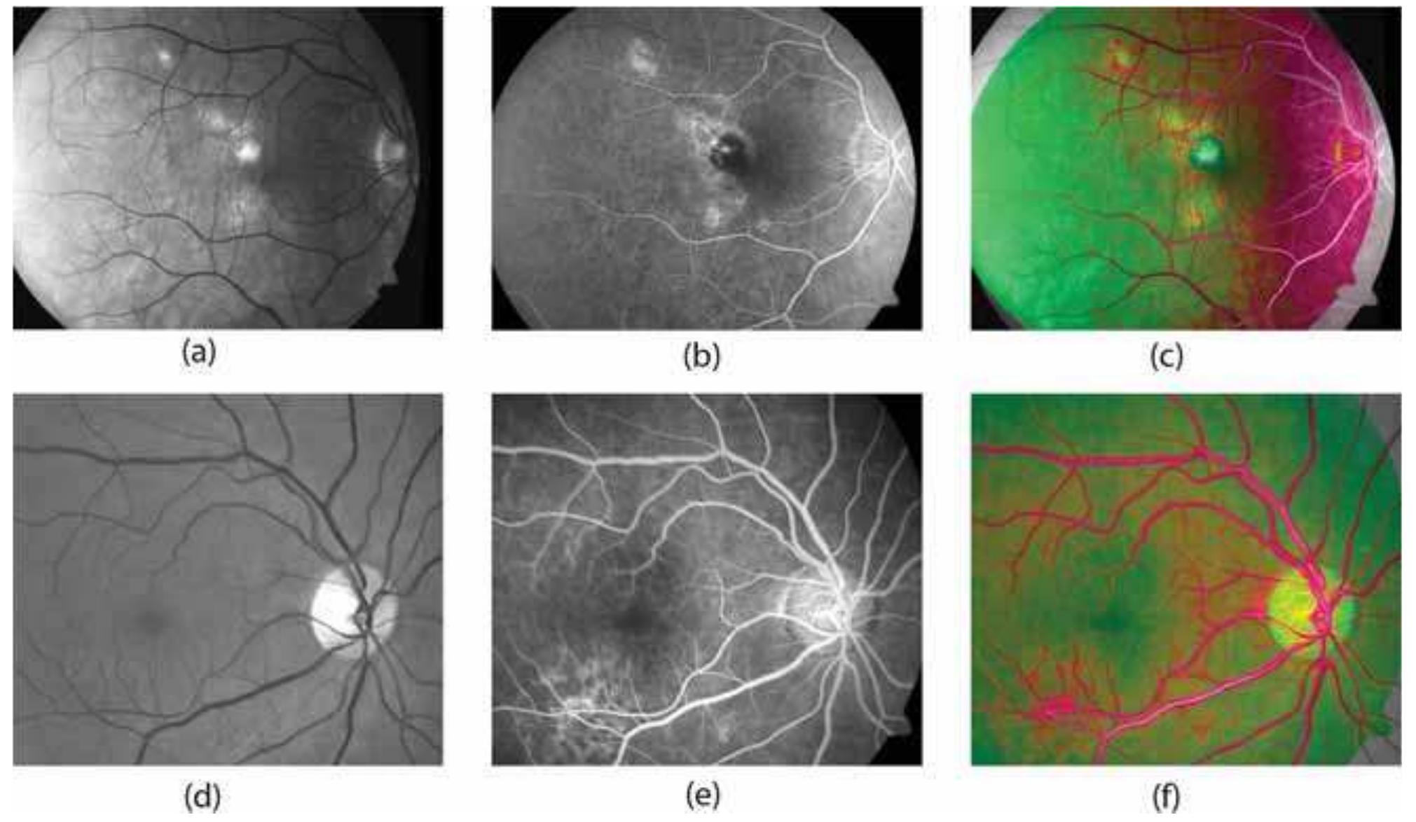(a) and (d) photographs, (b) and (e) fluorescein angiogram