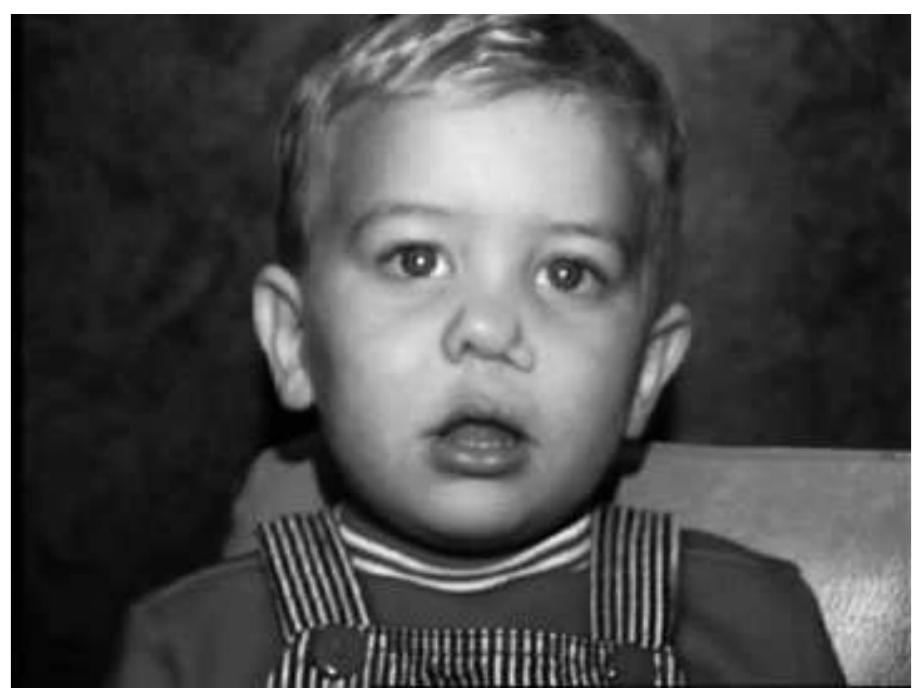 Unilateral cleft nose deformity. figures 1 and 5 depict the