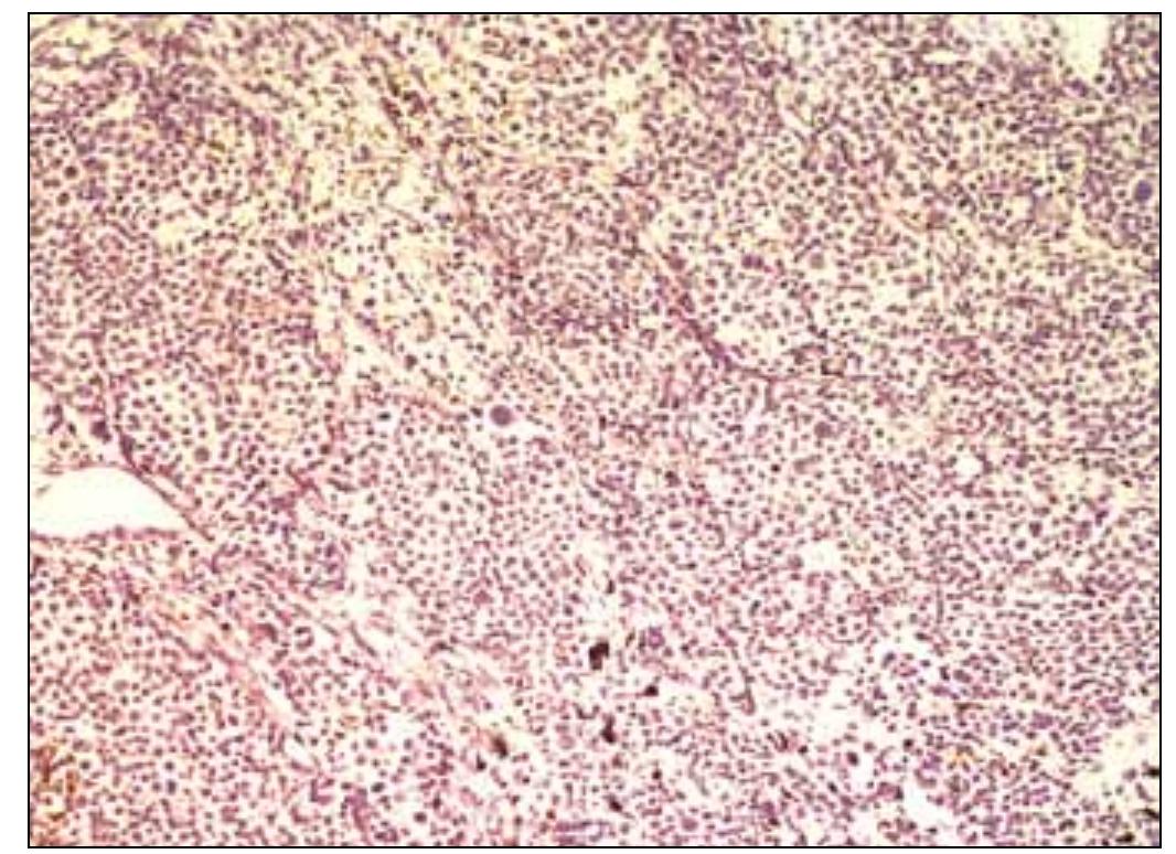 Paraffin sections reveal solid tumor infiltration consisting