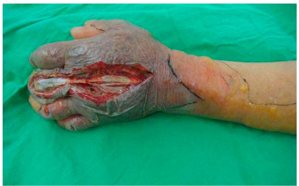 Fic. 1. hemorrhagic bullae with skin necrosis of the wounded