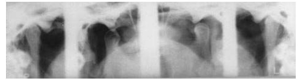 Case 1. panoramic radiograph showing bifid bilateral