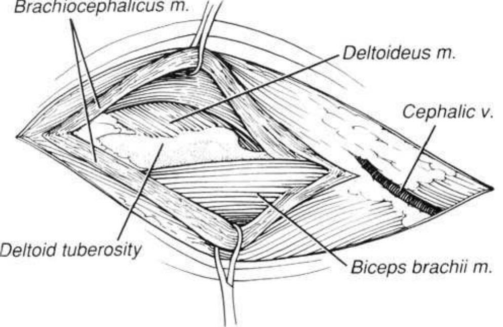 The brachiocephalicus muscle is split, showing the