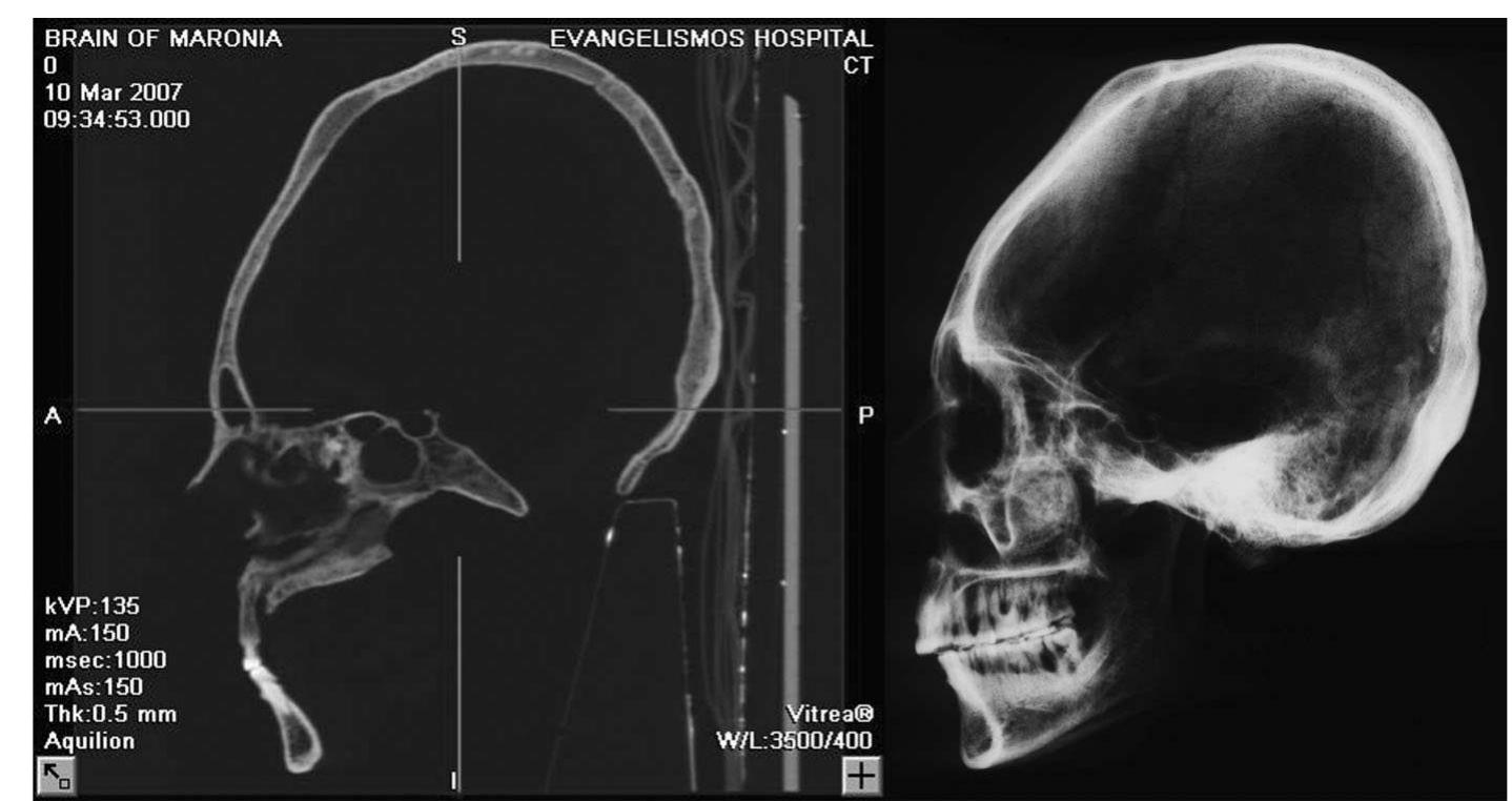 Left lateral scan section (a) and left lateral x-ray (b) of