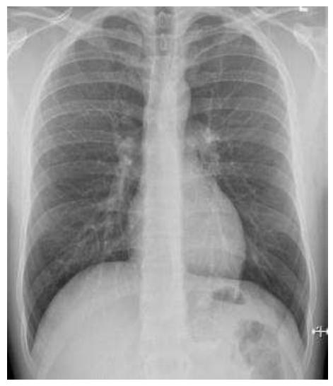 A typical x-ray radiograph of the chest, in which the