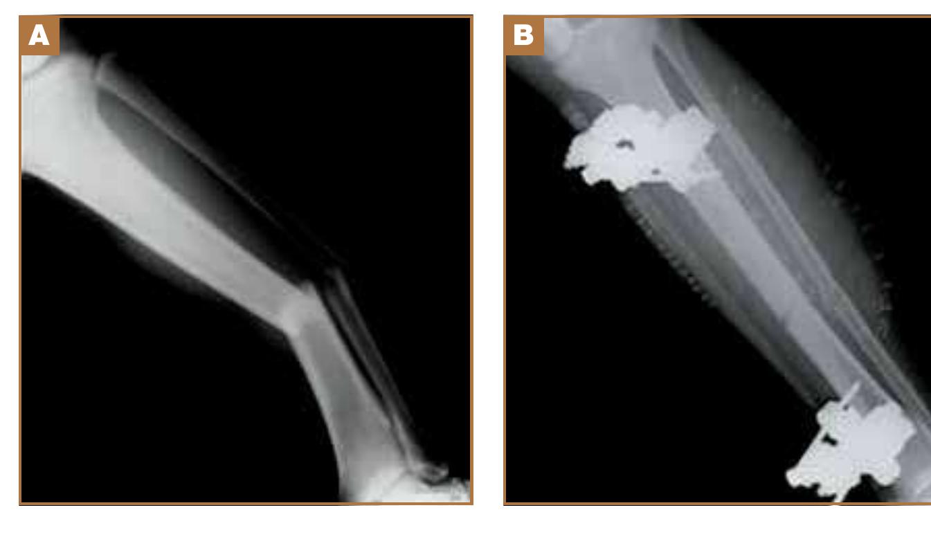 Anteroposterior radiograph of isolated tibia and fibula