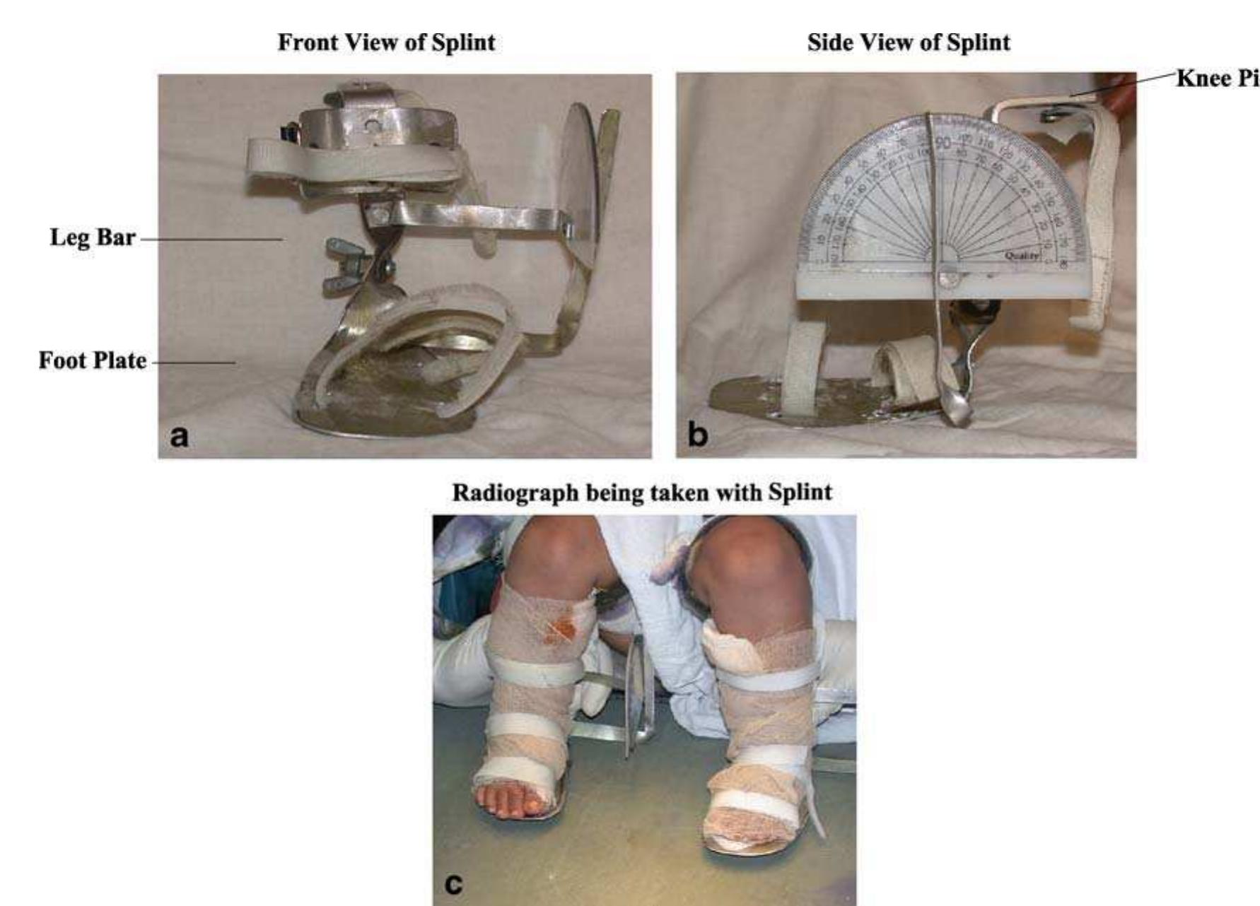 A front view of splint; b side view of splint; ¢ radiograph
