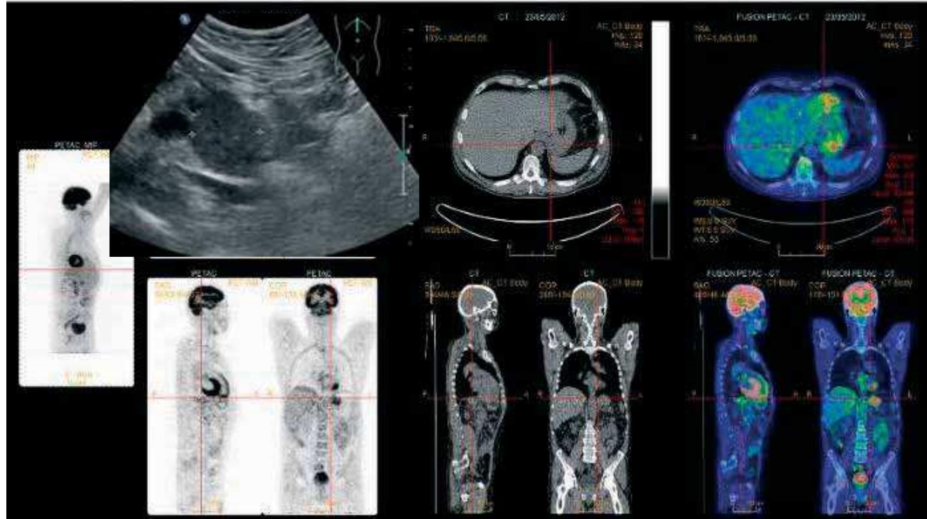 Multimodal imaging with ultrasound and pet-ct of pancreatic