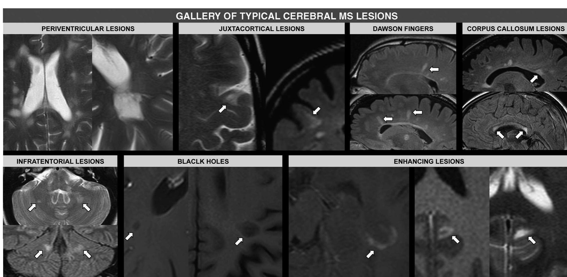 Typical cerebral ms lesions: periventricular t2w lesions