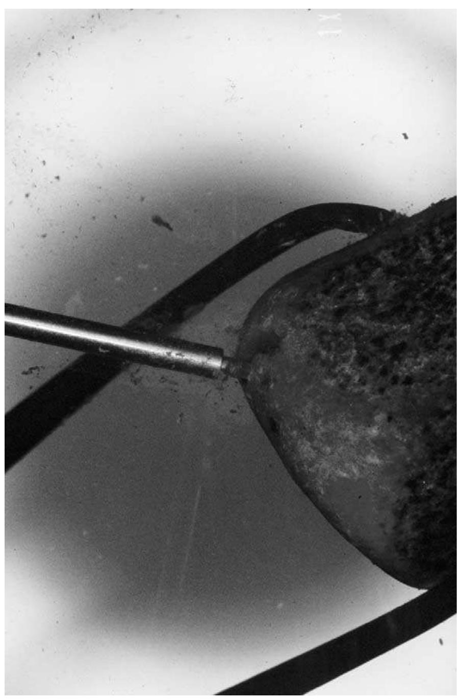 Ho:yag laser lithotripsy of a biliary calculus (in vitro).