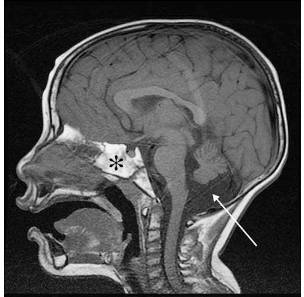 Sagittal t1-weighted mr image of the brain demonstrates