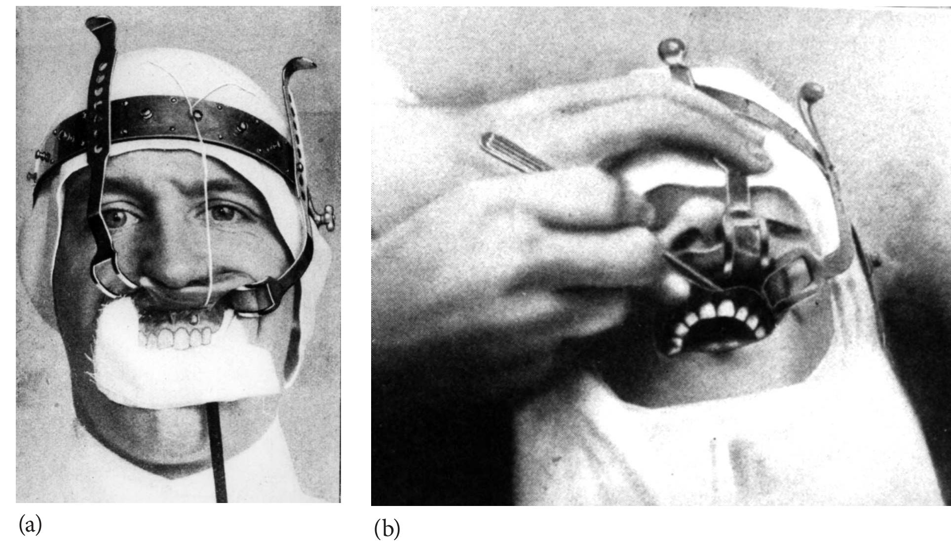 (a) patient wearing the killian head band modified for use