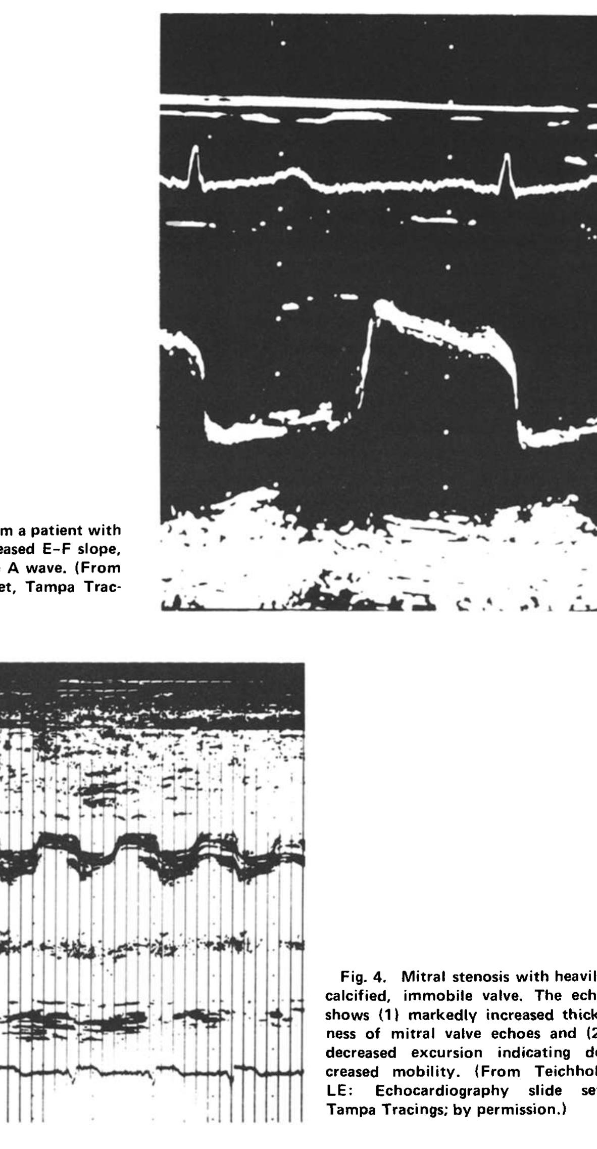 Figure 4 - Echocardiography in valvular heart disease