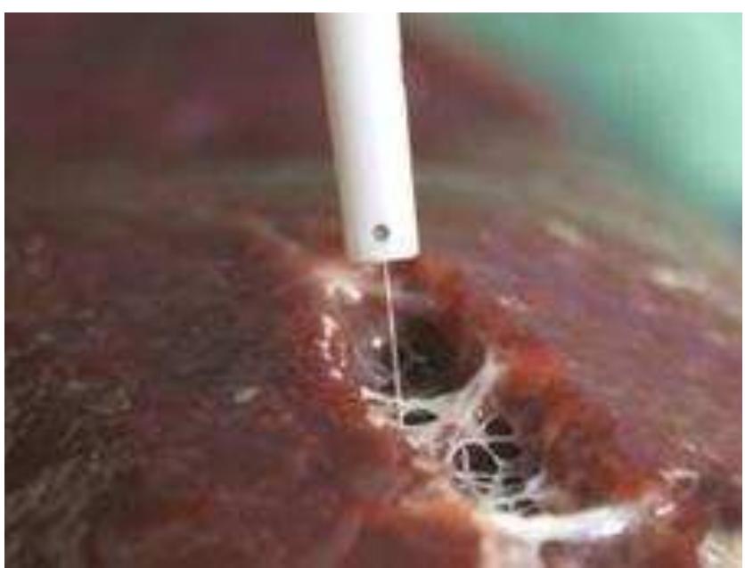 3: rotating hinge knee prosthesis (adapted from (guenoun et