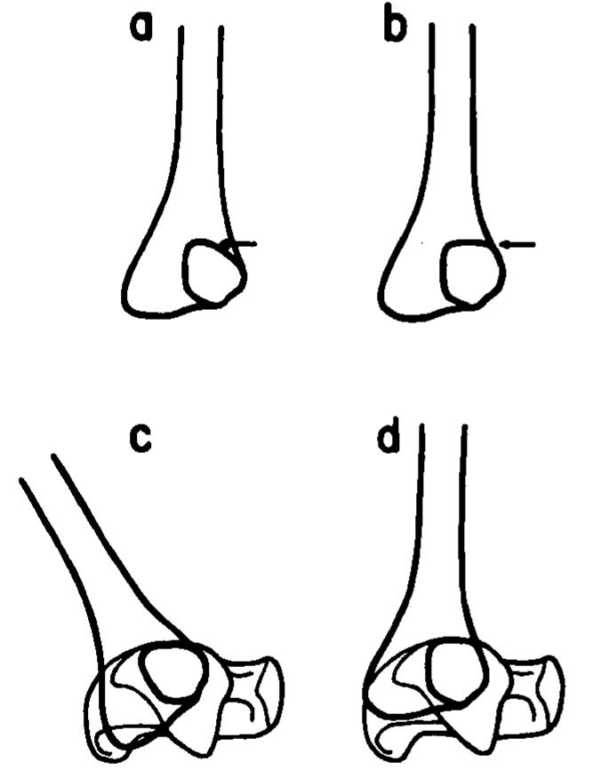 Schematic representation of the distal end of the fibula