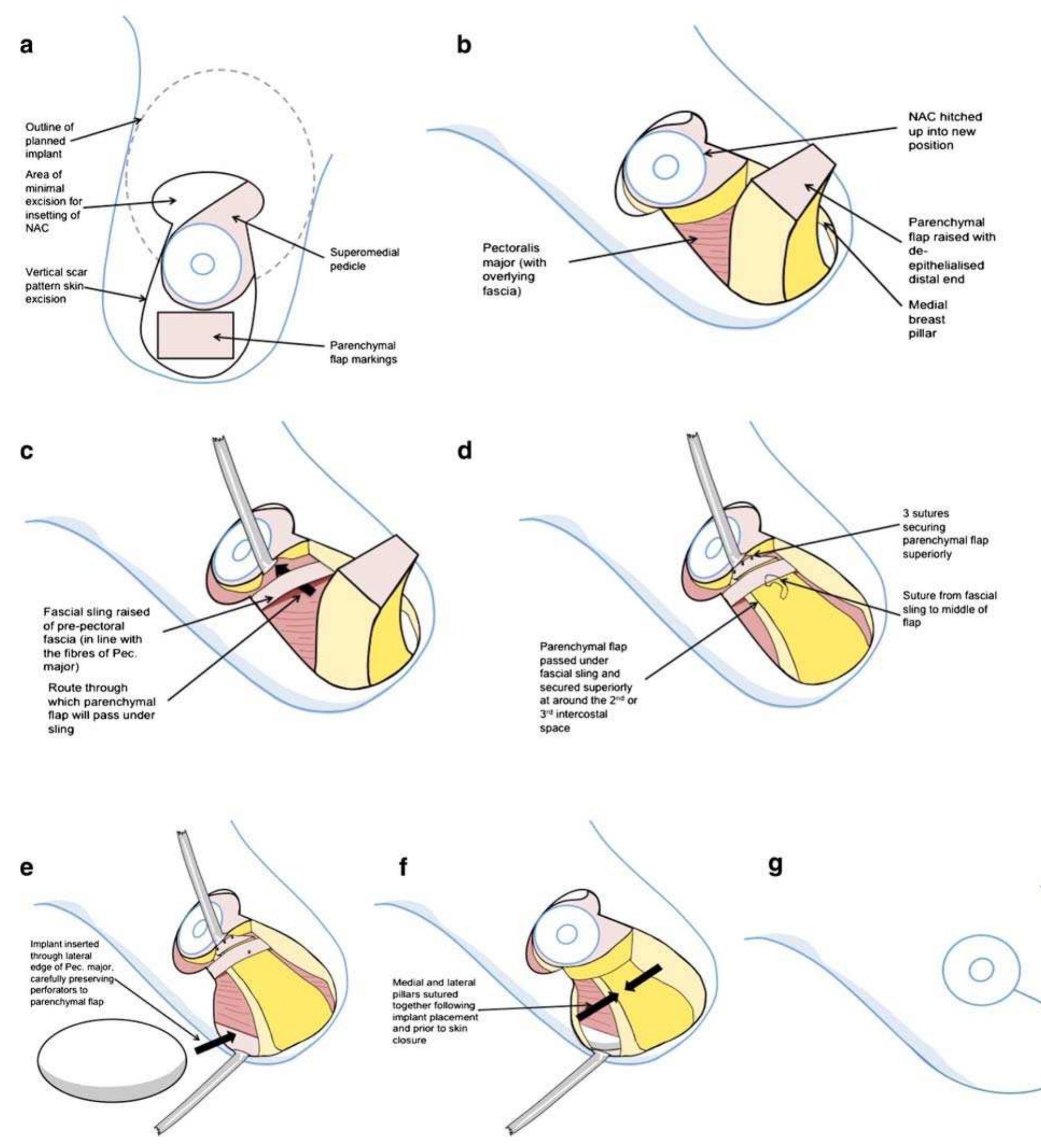 Schematics demonstrating the operative technique for com-