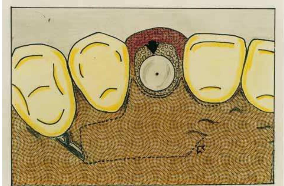 Diagram. implant in place (thick arrow). a sharp deep