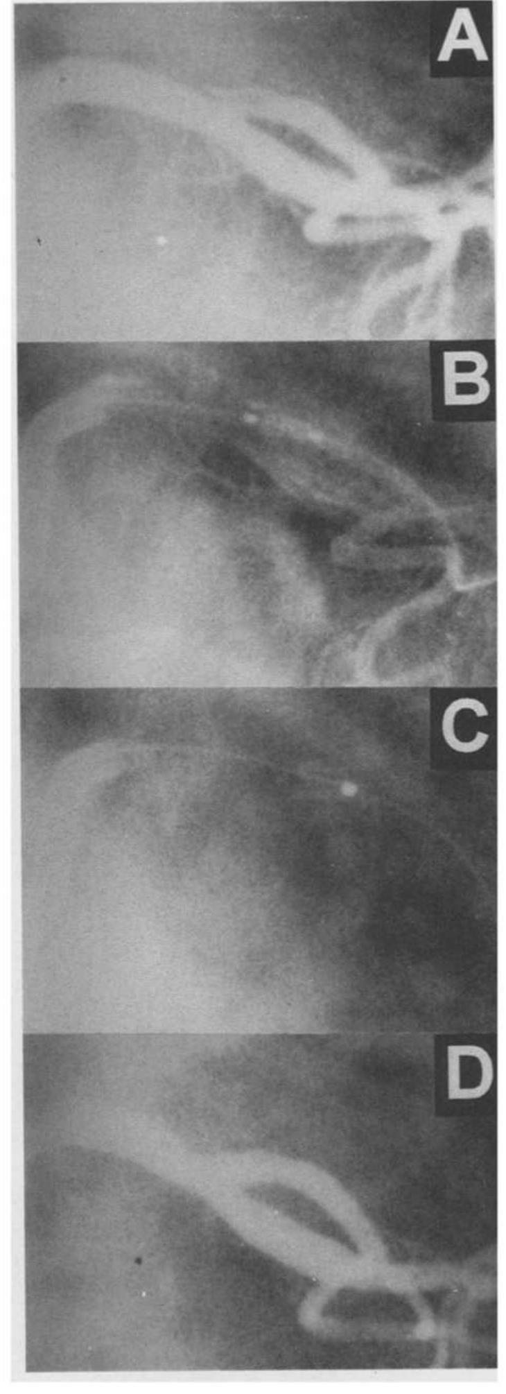 (a) short dissection in the origin of the left circum- flex