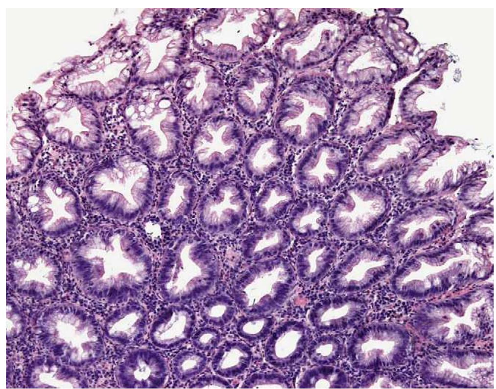 A4. histopathology of hp lesion. transverse section of the