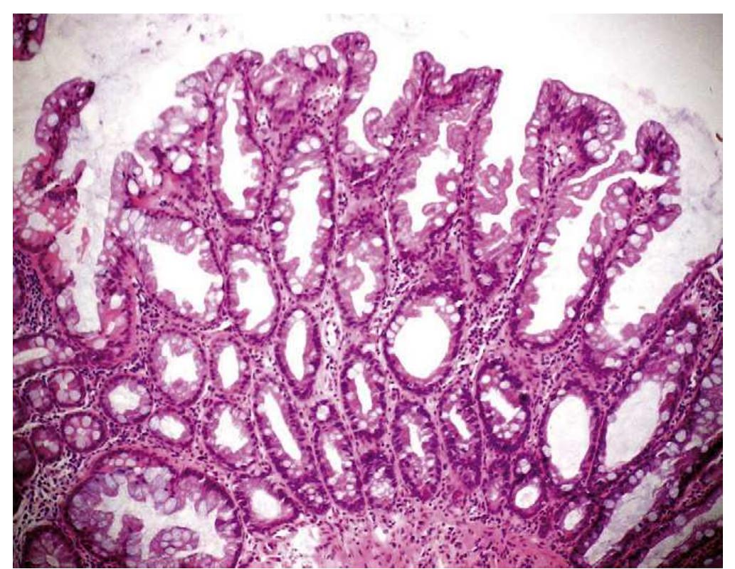 A5. histopathology of sessile serrated lesion. dilated