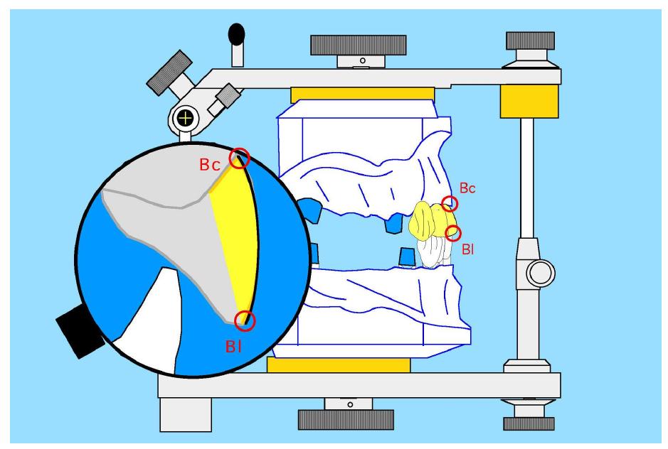 Octa 5: the position of the maxillary incisors is defined by