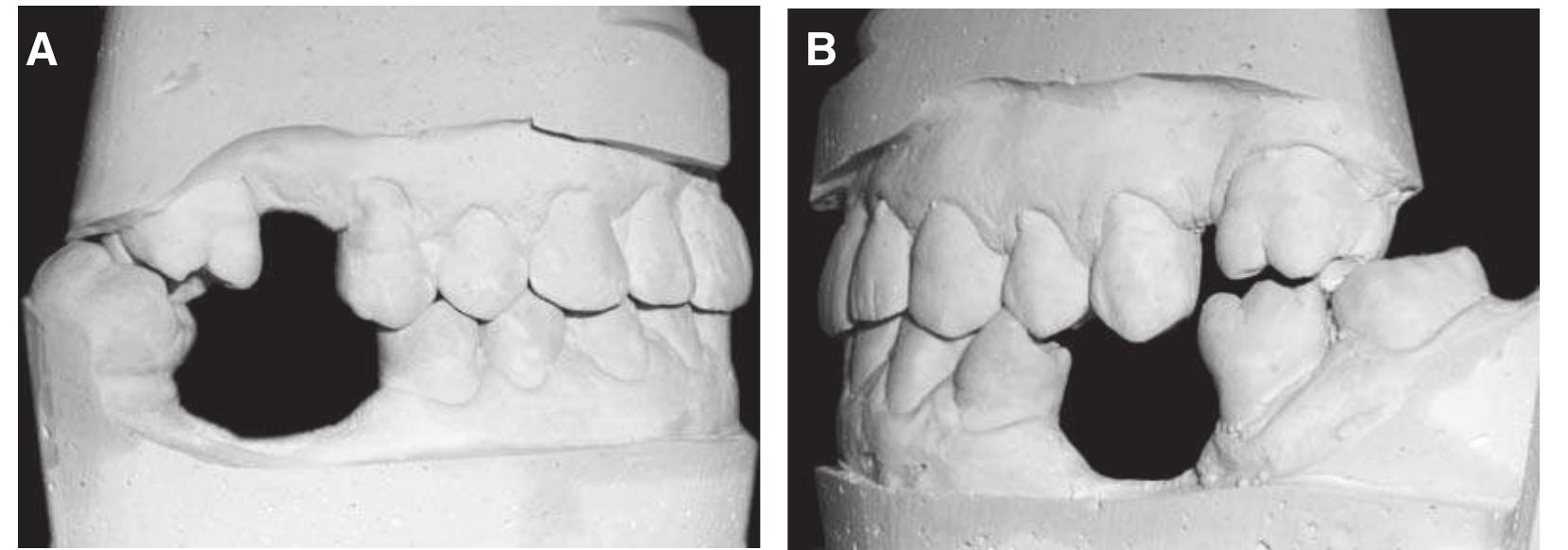 Loss of occlusal posterior support probably without loss of