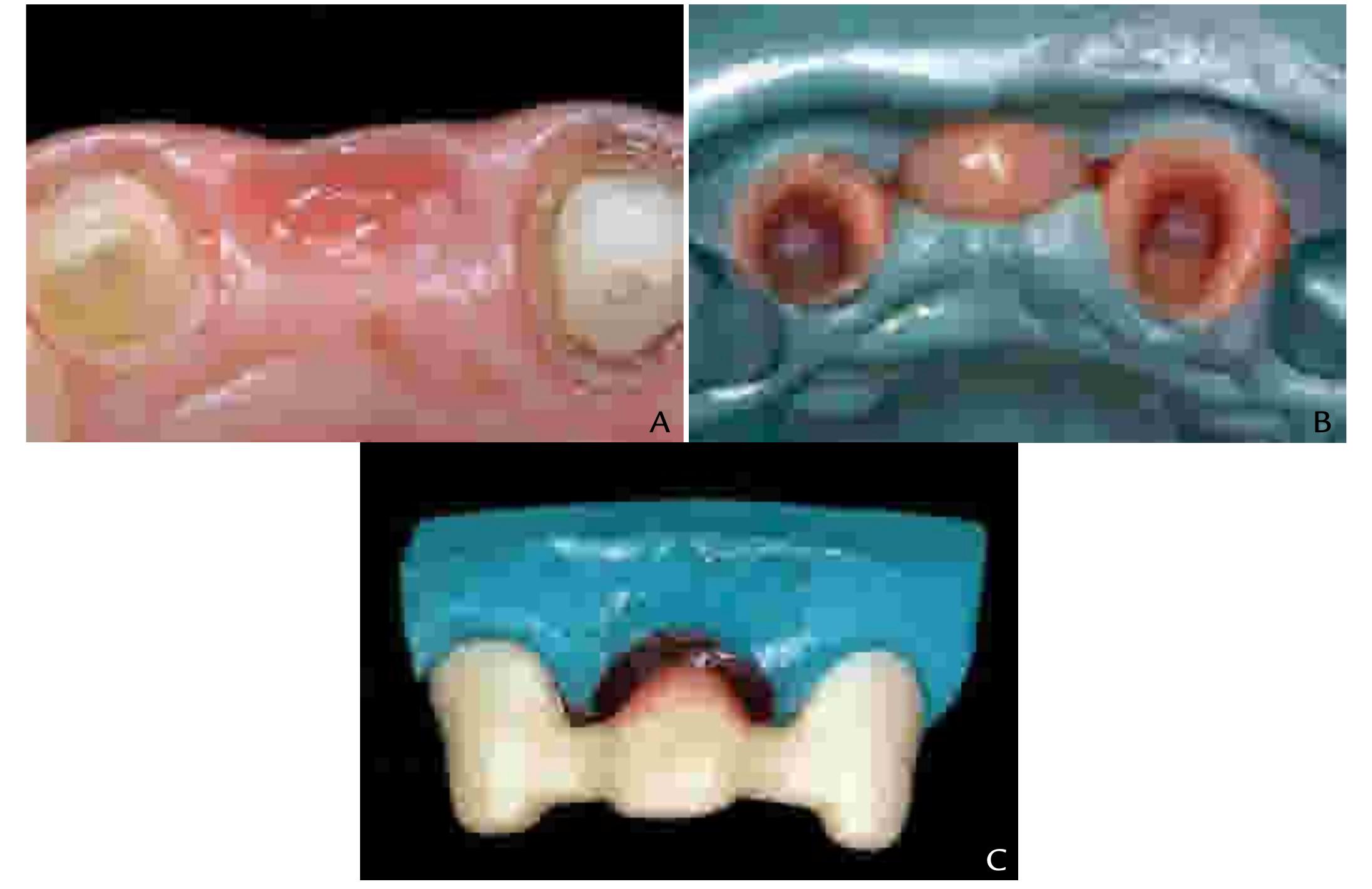Ha, occlusal view of sculpted alveolar mucosa. b,