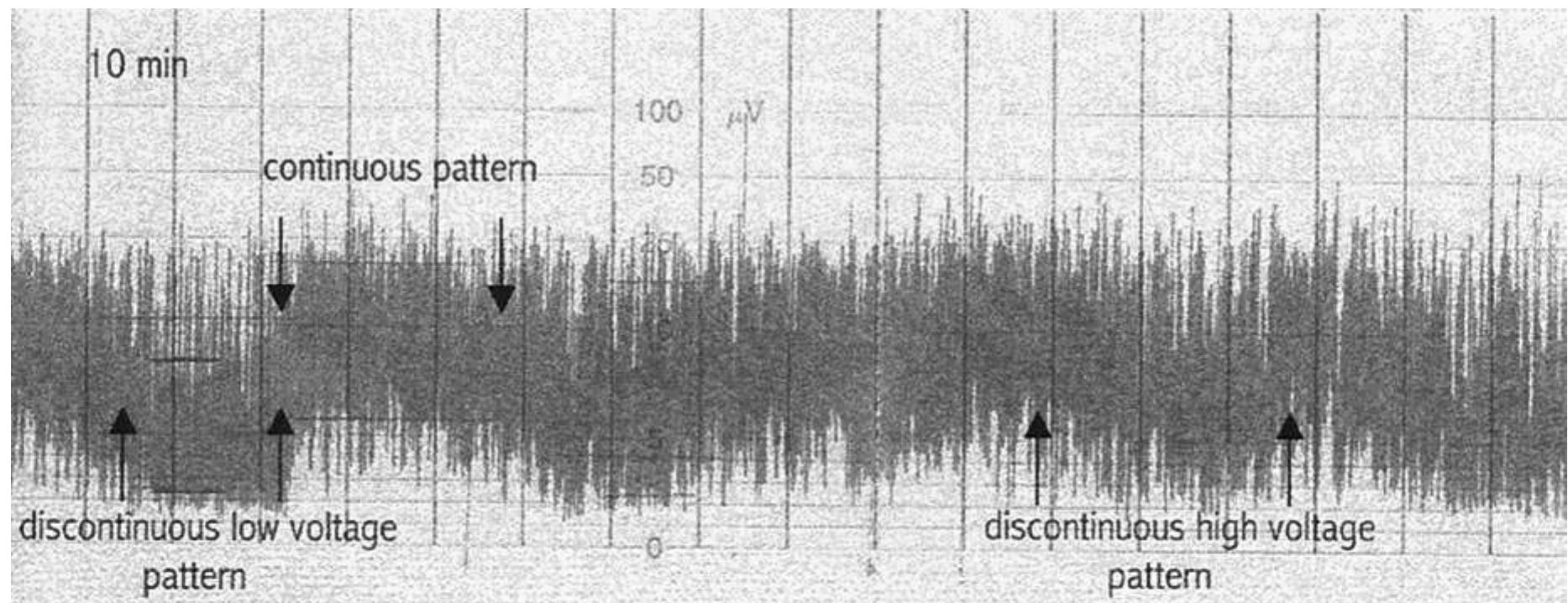 The 3 observed types of aeeg patterns in a patient of 28 + 2