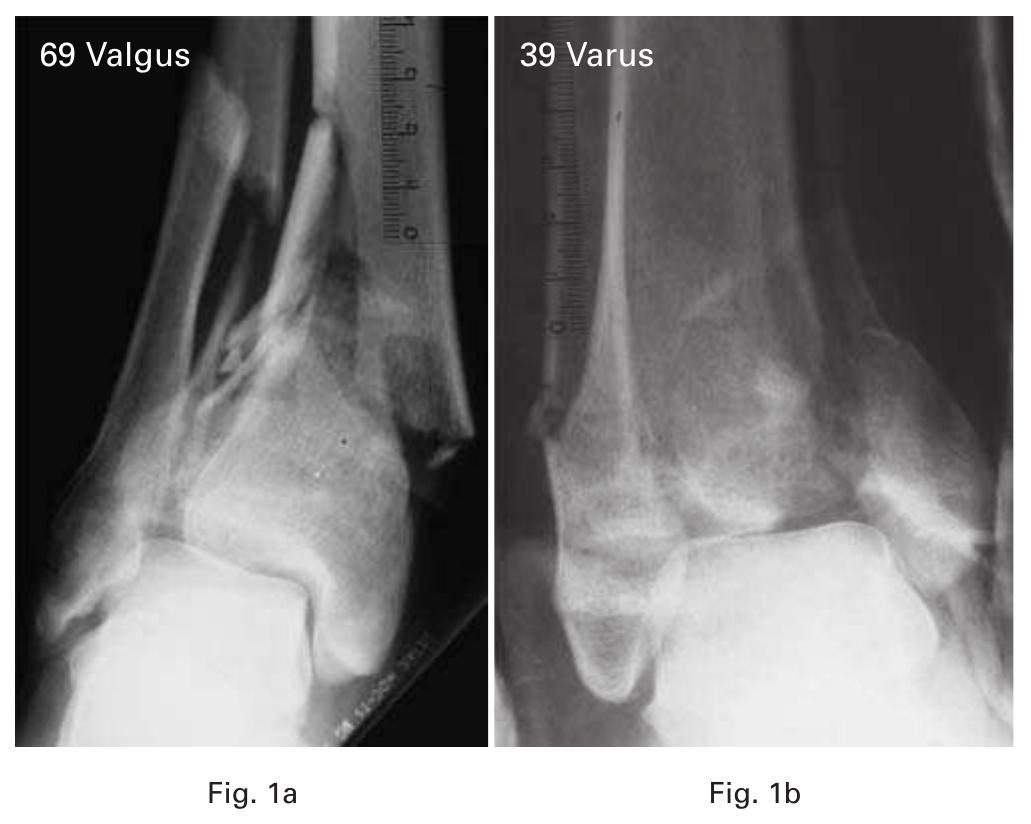 Radiographs showing pilon fractures in a) valgus and b)
