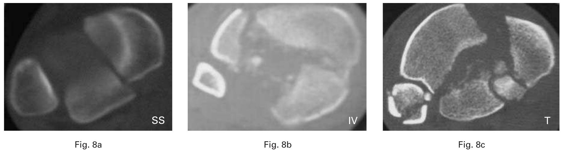 Ct scans of sagittal family fractures showing a) the