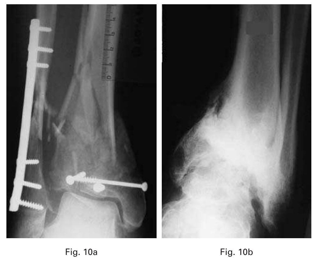 Figure 9 - Anatomy of pilon fractures of the distal tibia