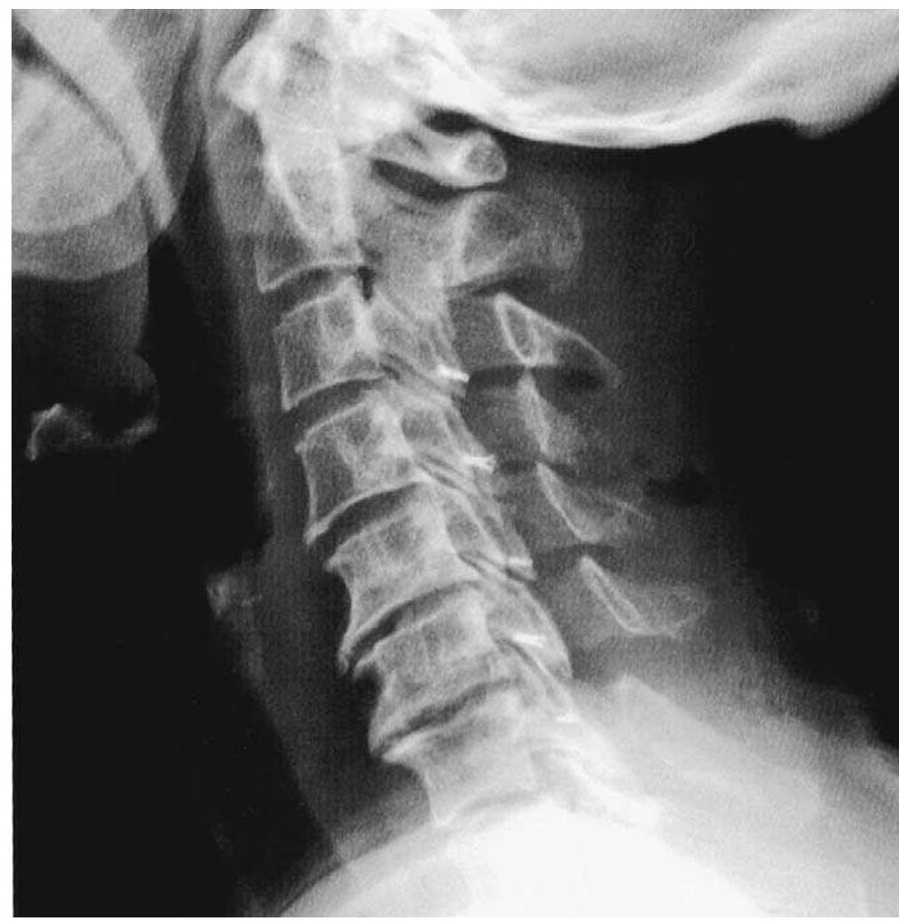 Lateral radiograph after open-door laminoplasty from c3 to